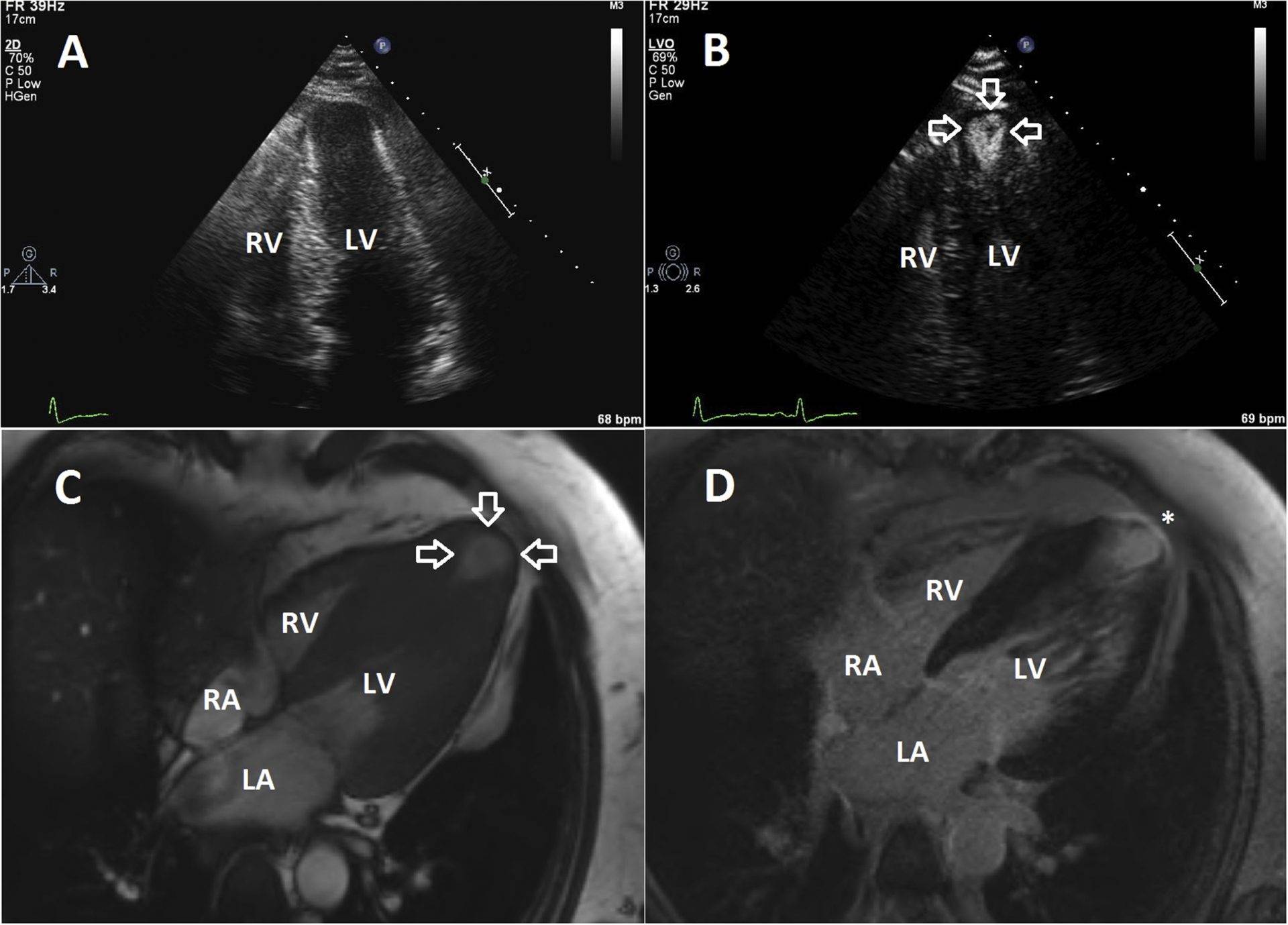 2021 | Left Ventricular Apical Aneurysms in Hypertrophic Cardiomyopathy ...